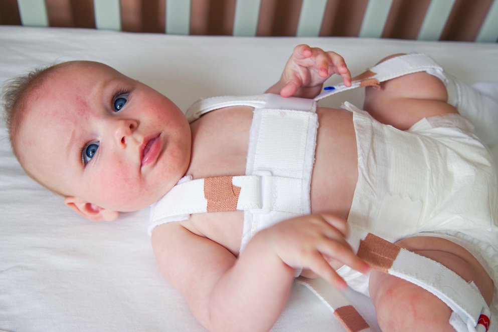 Understanding Hip Dysplasia in Babies: Causes, Symptoms and Treatment